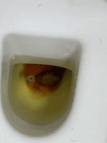 30 Male (110kg) - Blood in Stool (see picture : r/AskDocs